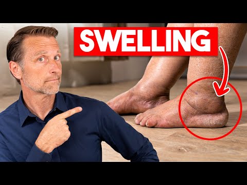 #1 Vitamin to Eliminate Swollen Legs and Ankles – Healthy Living